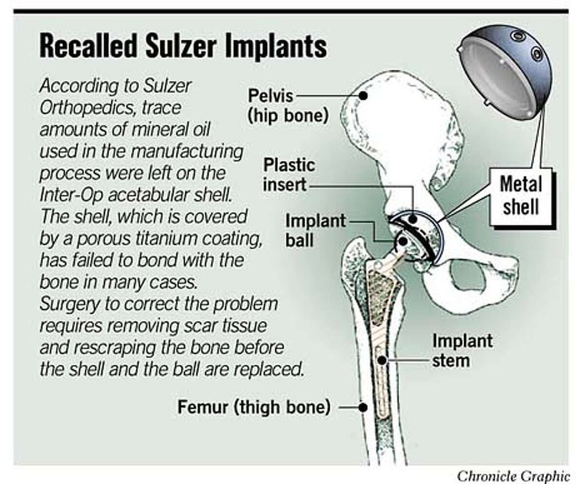 Physicians Race to Replace Hip Implants / Recall of 31,000 faulty ...