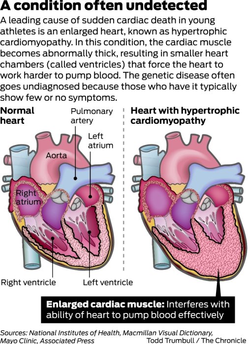 Runners' heart woes can be discovered too late