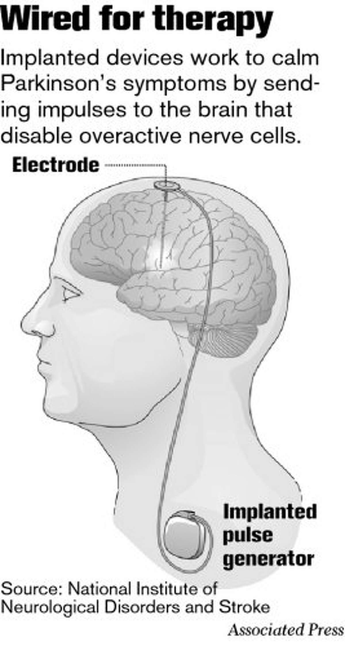 Brain pacemaker found big help for Parkinson's