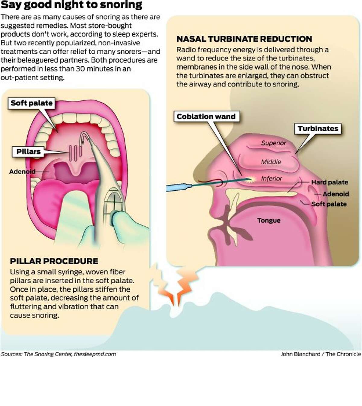 Snoring is more than a mild annoyance