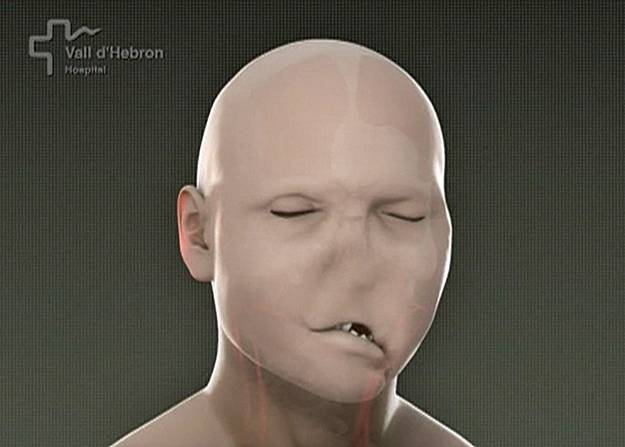 Spanish surgeons replace man's face