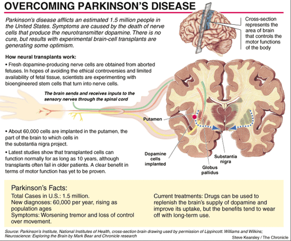 Solving the Parkinson's Puzzle / Scientists report promising results in ...