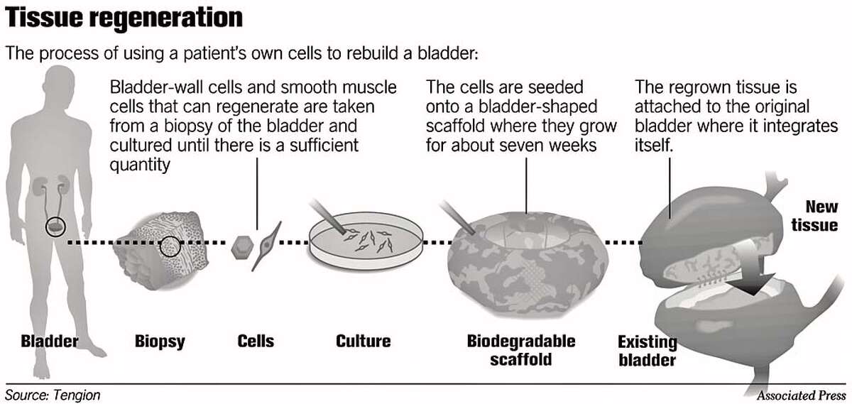 Bladders grown from patients' own cells show promise / Formed in 2 ...