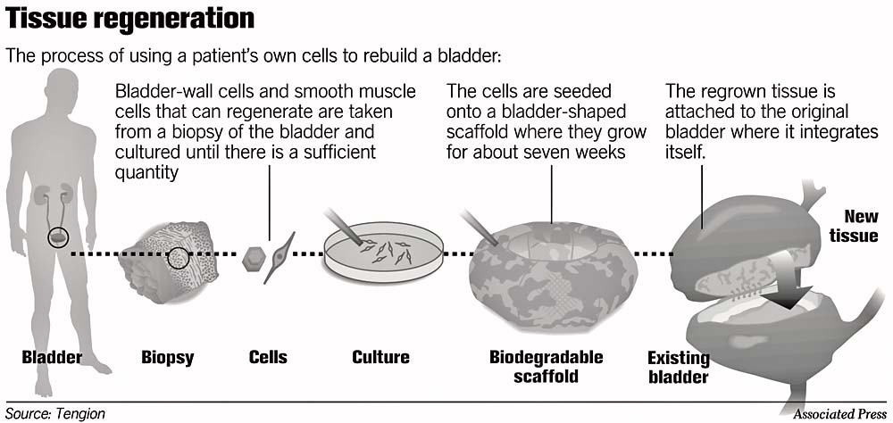 Bladders grown from patients' own cells show promise / Formed in 2 ...