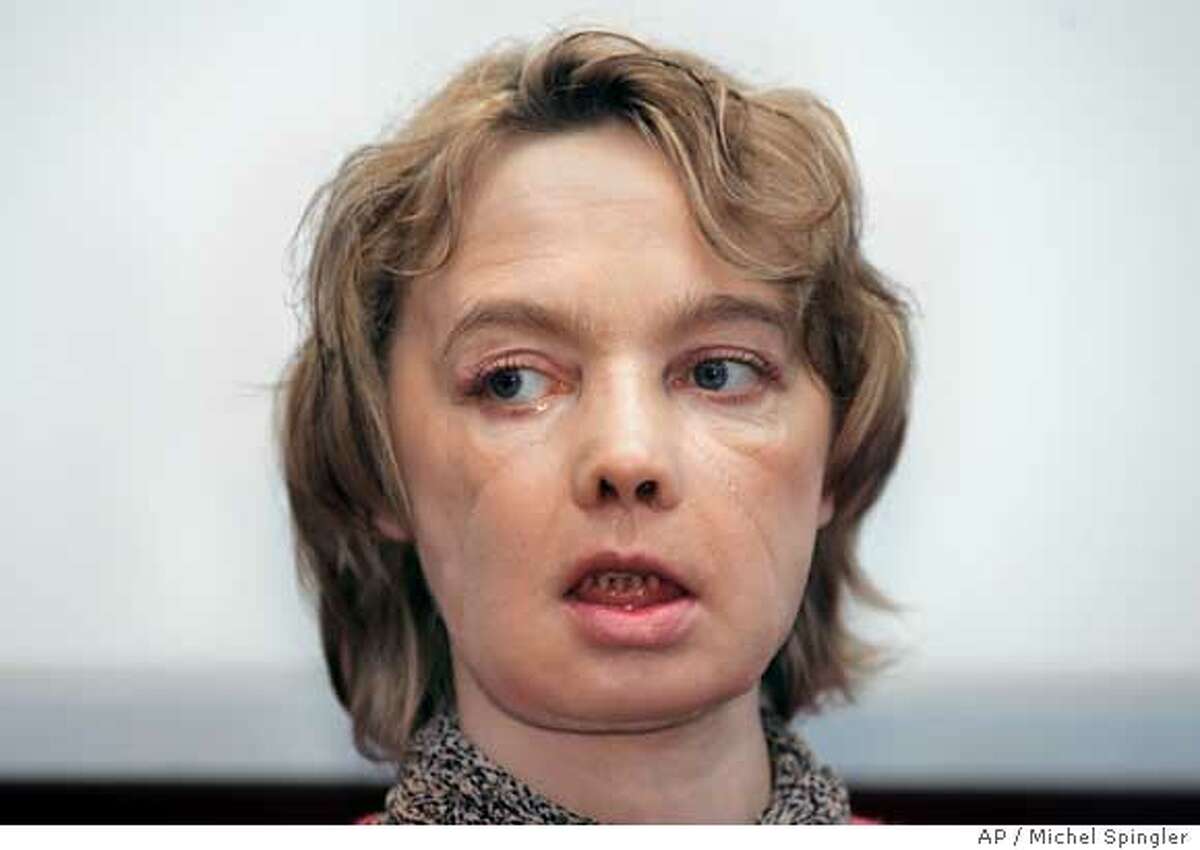 Face transplant woman appears / French citizen thanks doctors, donor ...