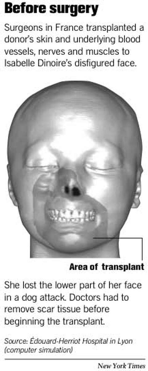 Face transplant woman appears / French citizen thanks doctors, donor ...