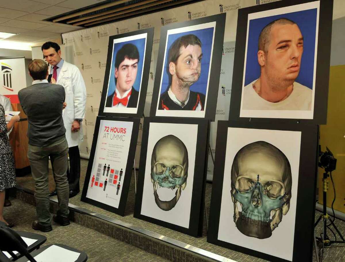 Photos: Before and after face transplant