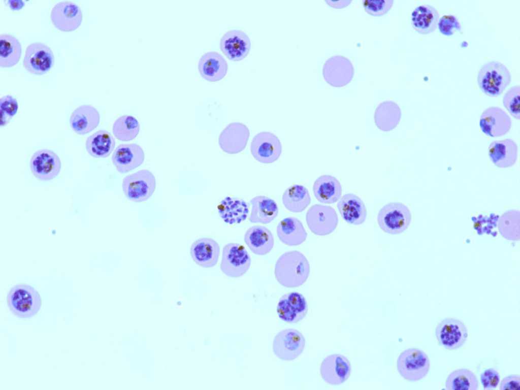 Drug-resistant malaria rising