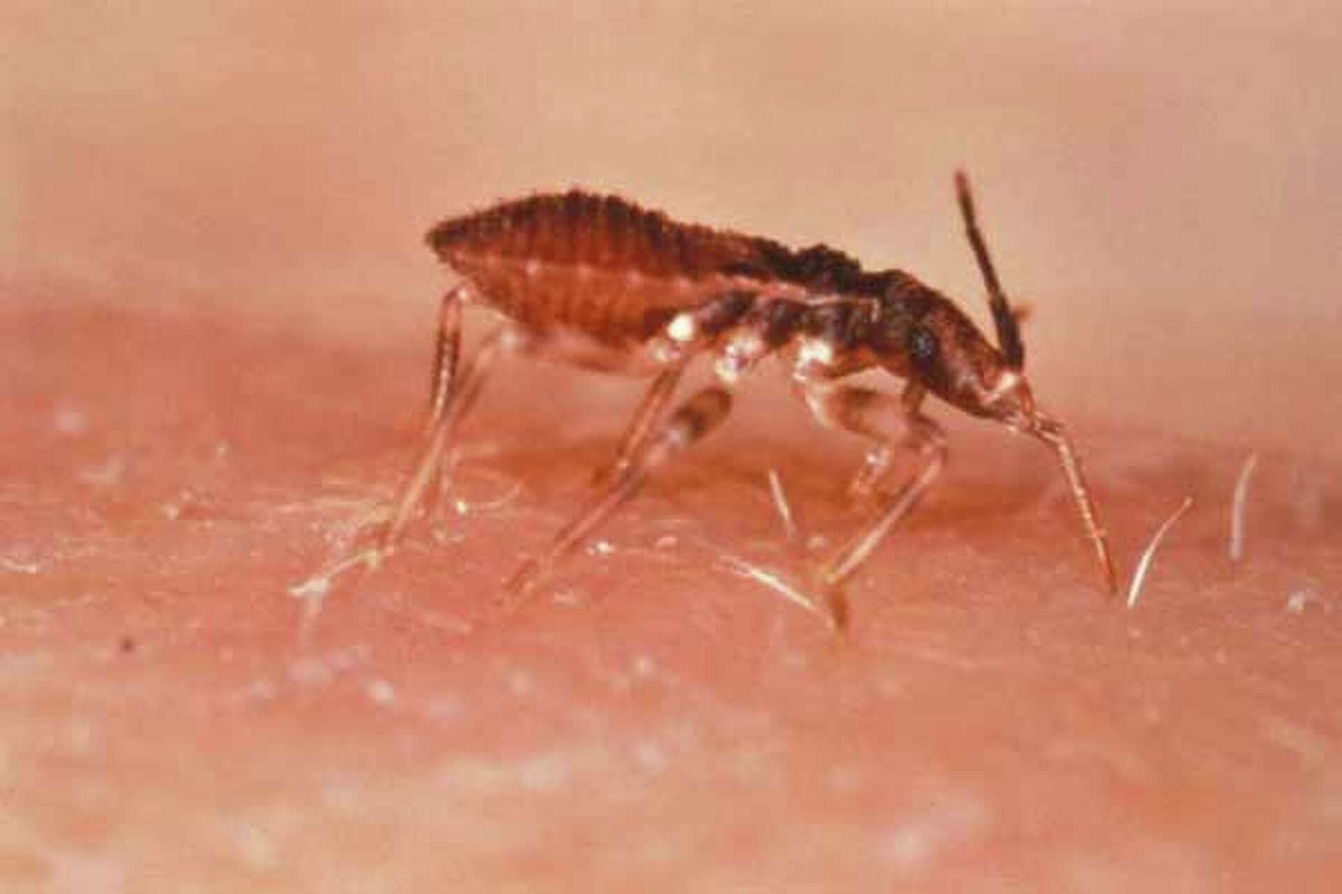 Chagas Disease