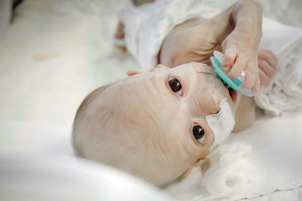 Baby Andrei, born with stunted intestines, dies