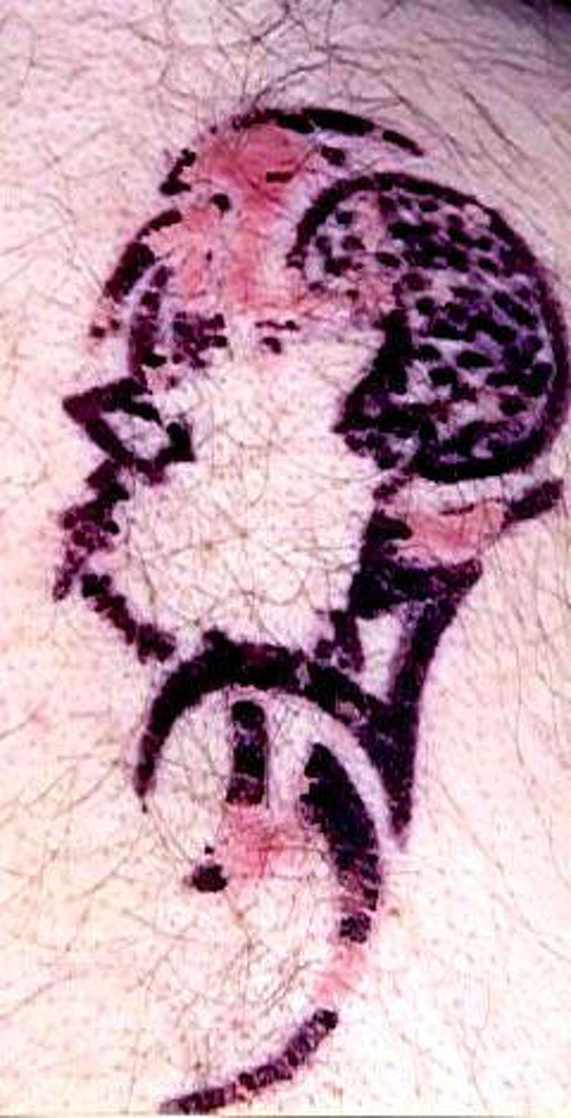 Beware of black henna, doctors warn