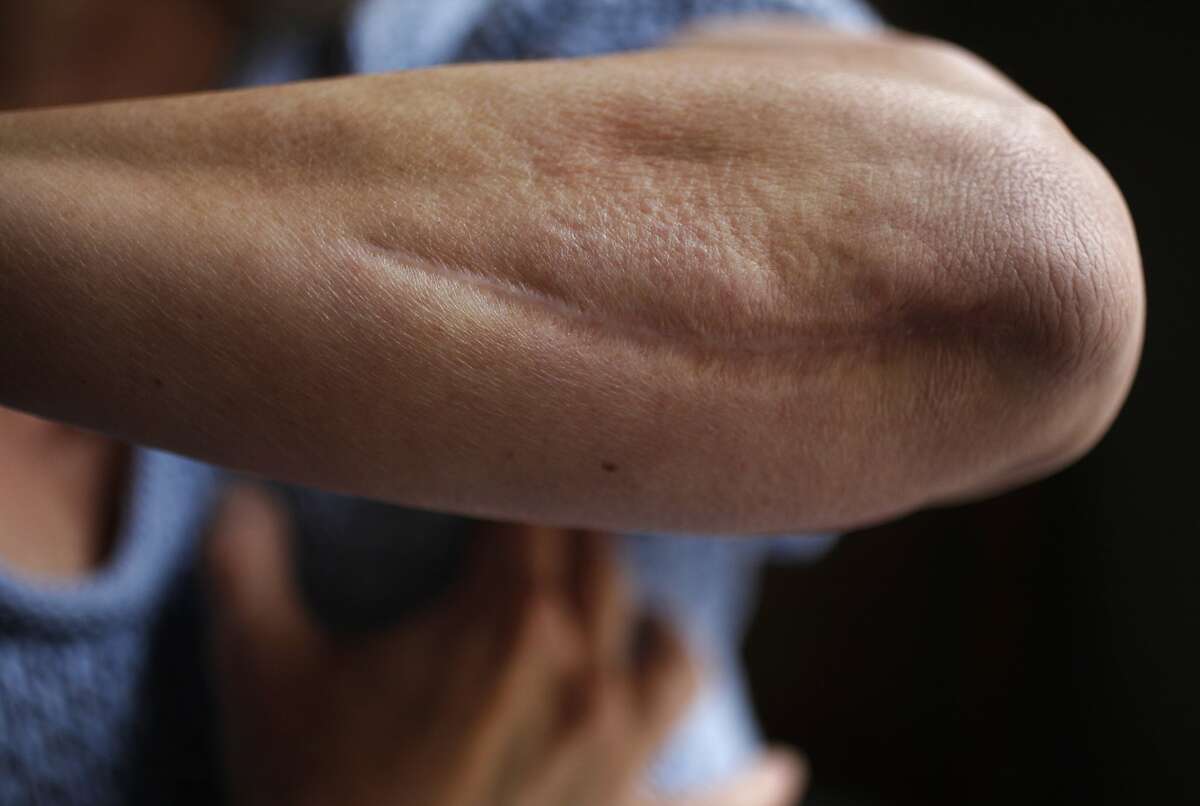 Doctor develops simple treatment for flesh-eating disease