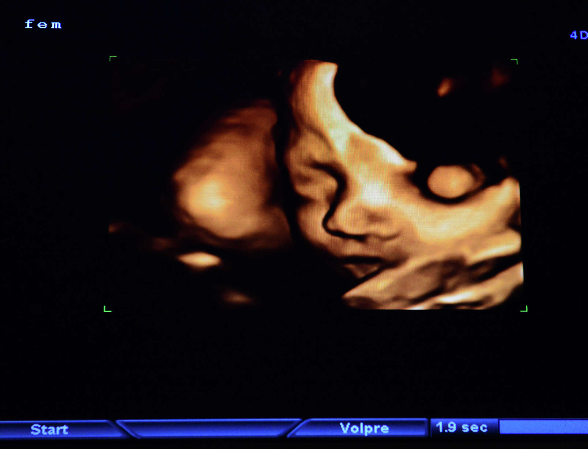 New prenatal test edging out amnio