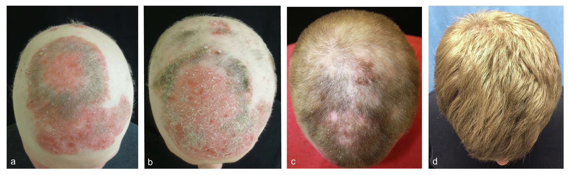 Yale researcher on brink of baldness cure