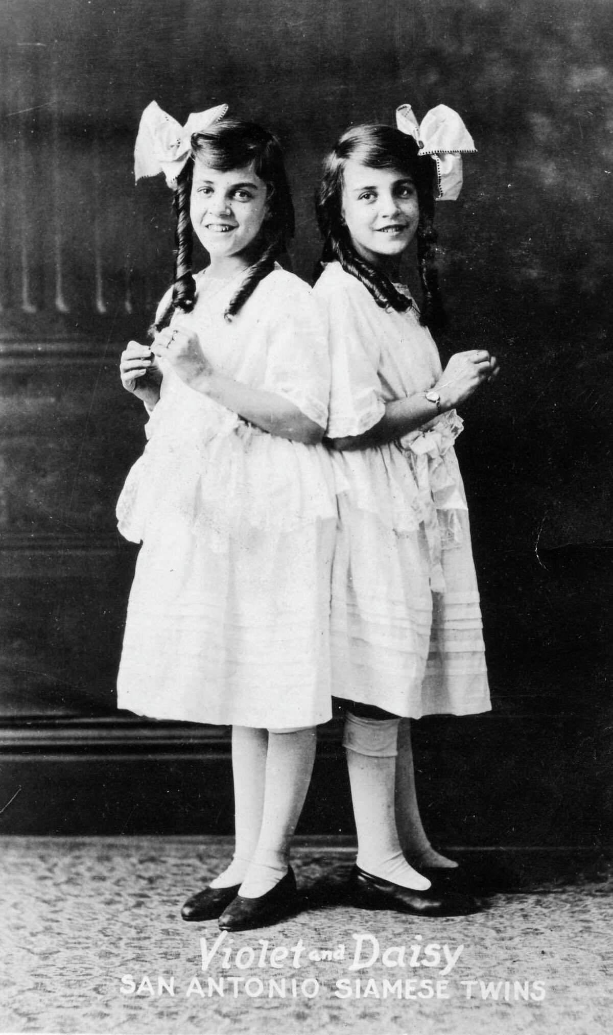 Rejected at birth, Siamese Twins found new life in S.A.