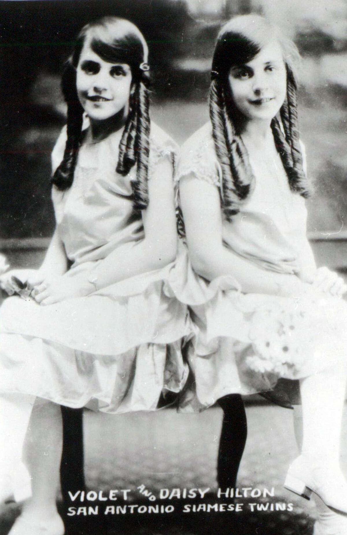 Film rich look at S.A.'s conjoined twins