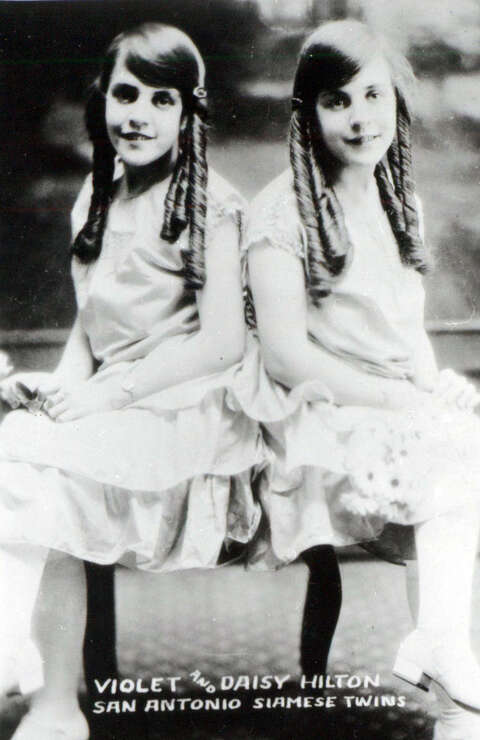 Film rich look at S.A.'s conjoined twins