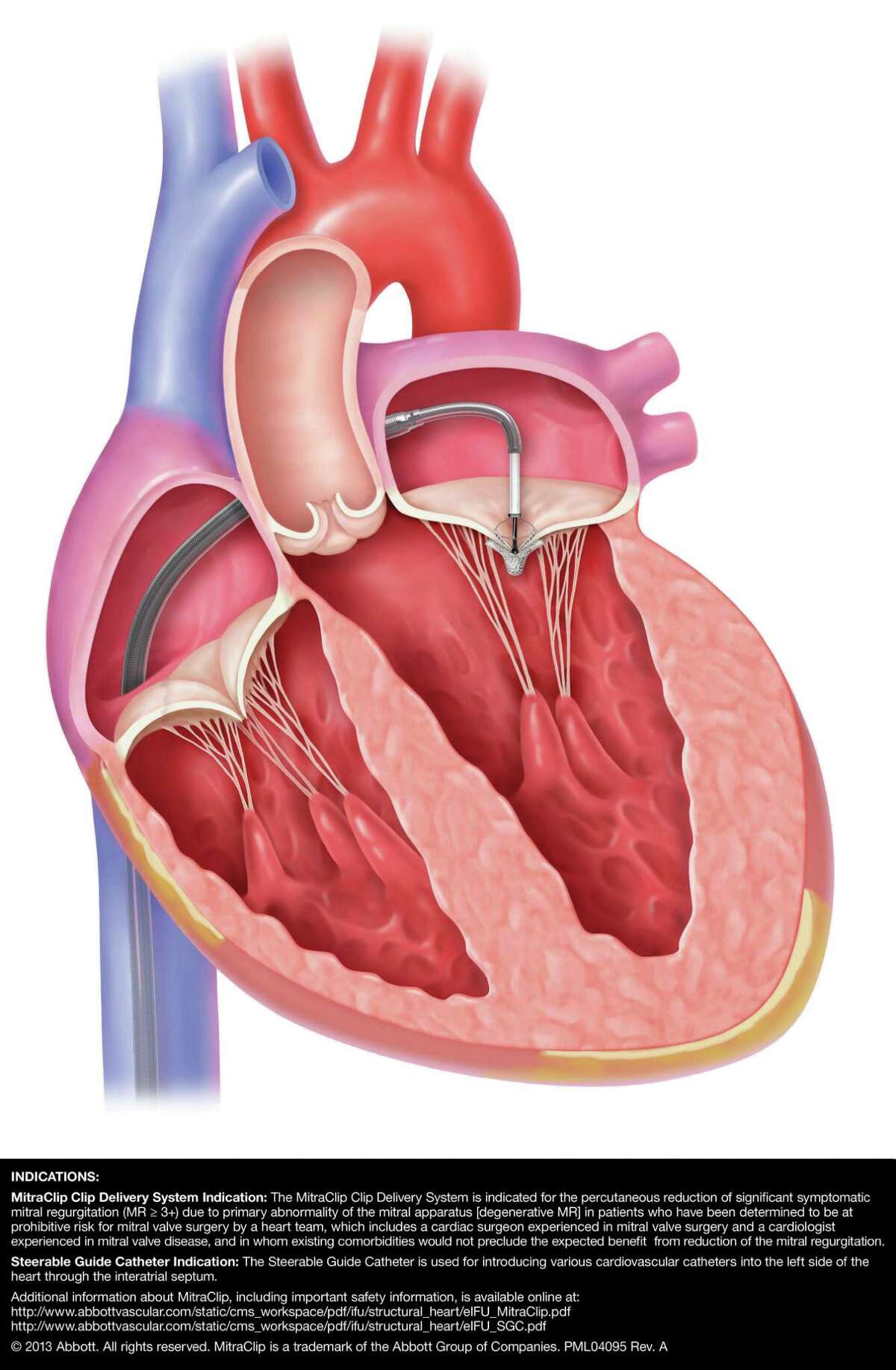 New 'plug' in leaky heart valve avoids need for more invasive procedure
