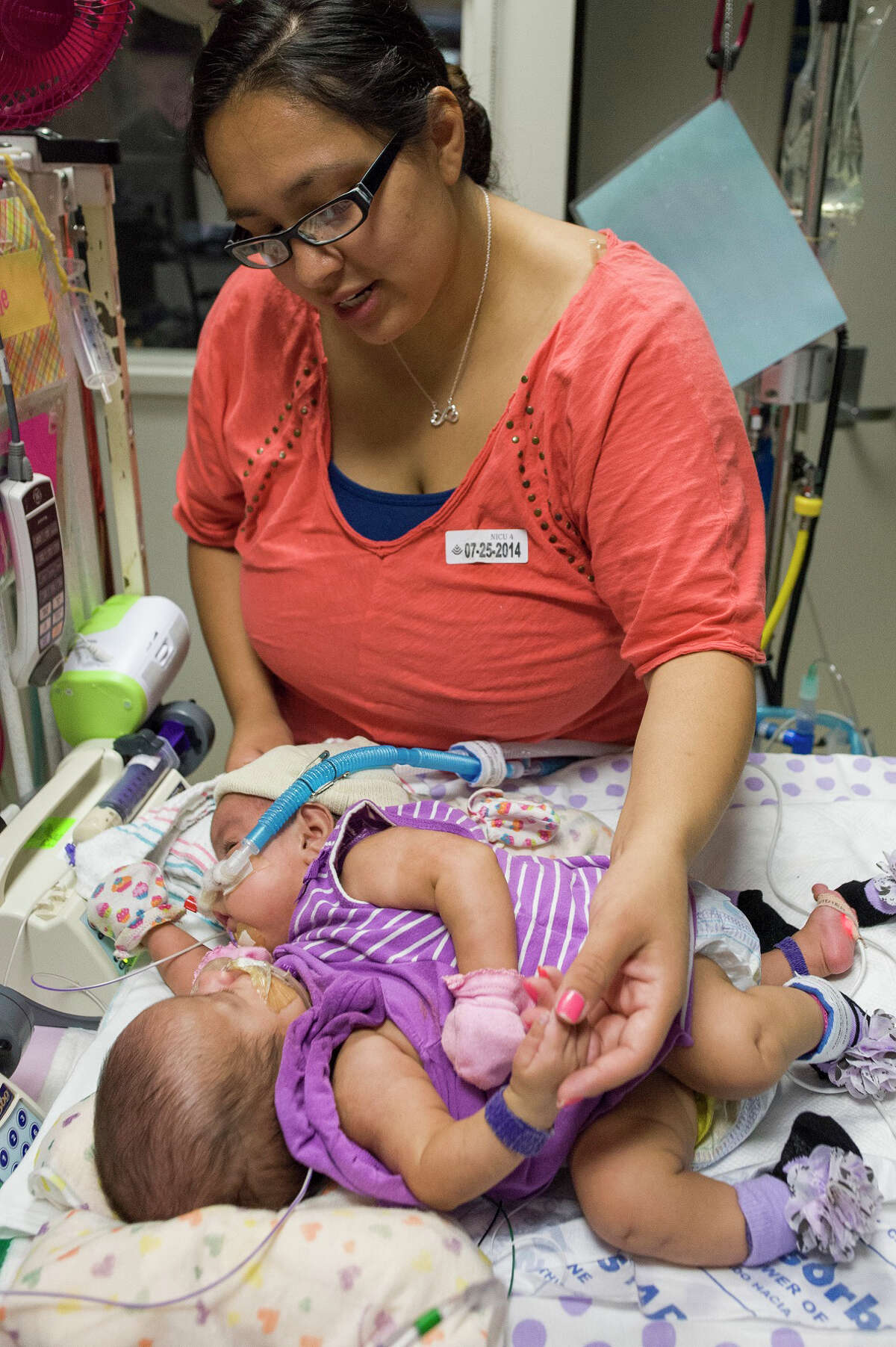 Conjoined twins separated at Texas Children's Hospital