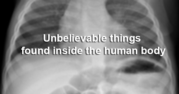 Strange things found in the human body