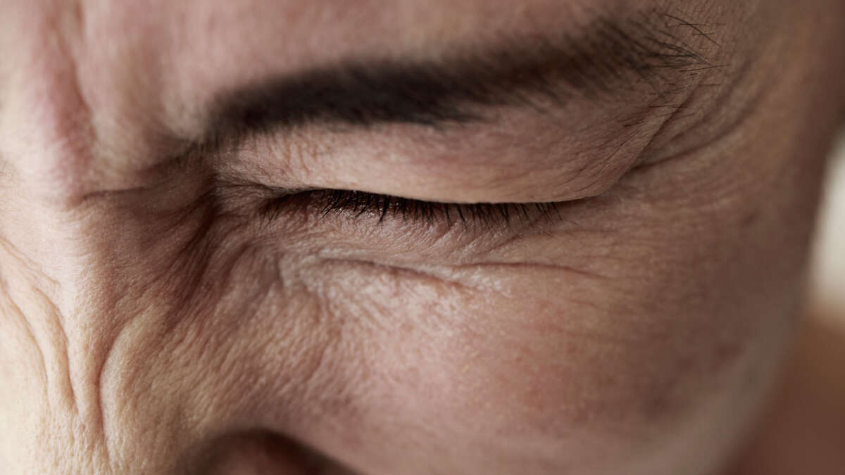 Pimple under woman's eye turned out to be skin cancer