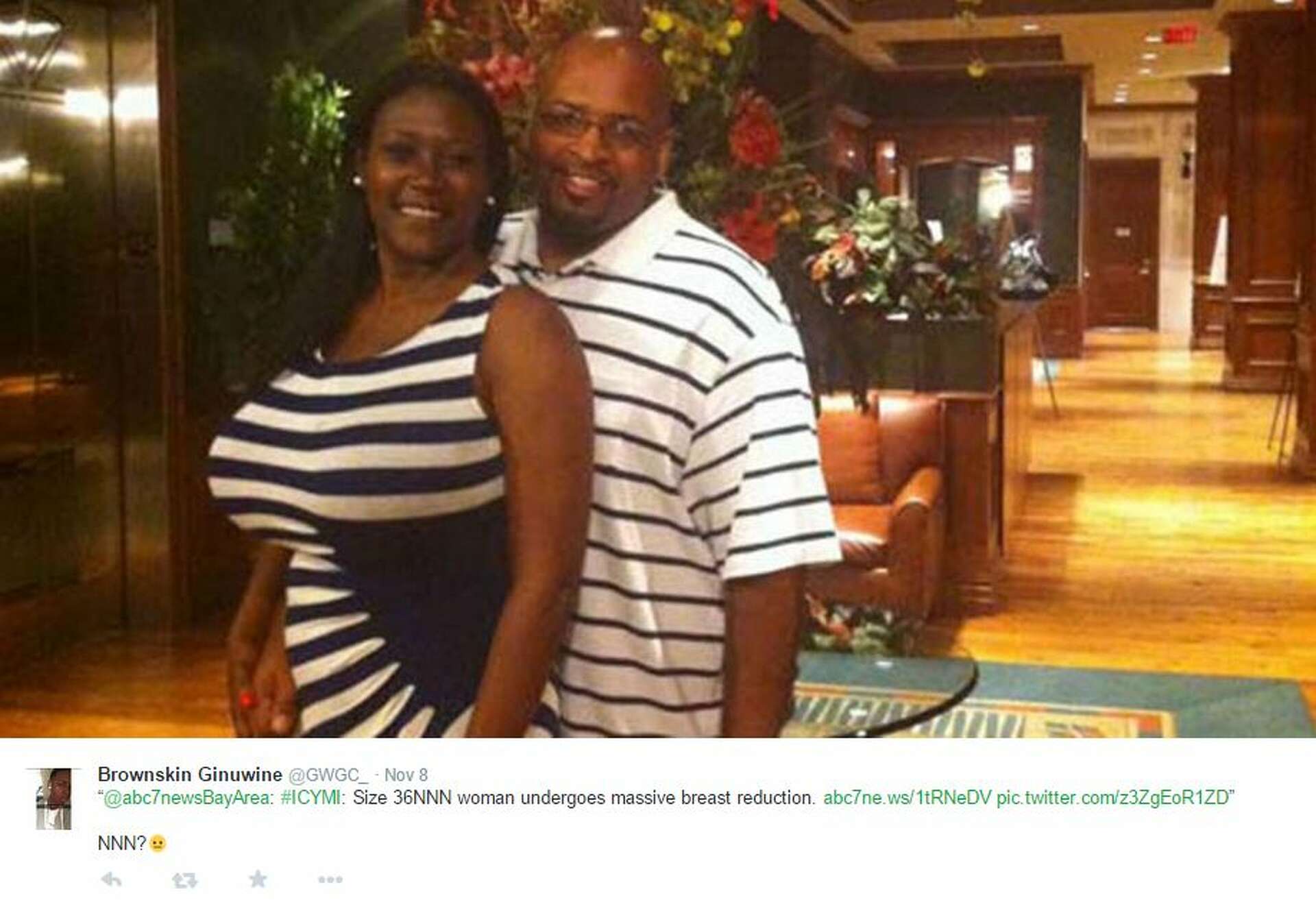 Rare condition causes Texas woman to undergo reduction for 36NNN breasts