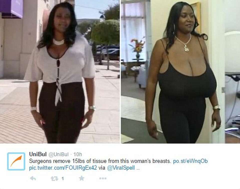 Rare Condition Causes Texas Woman To Undergo Reduction For 36nnn Breasts