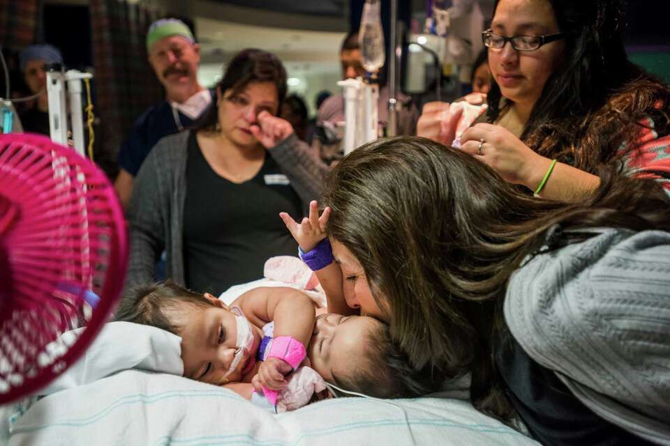 Conjoined twins separated at Texas Children's Hospital