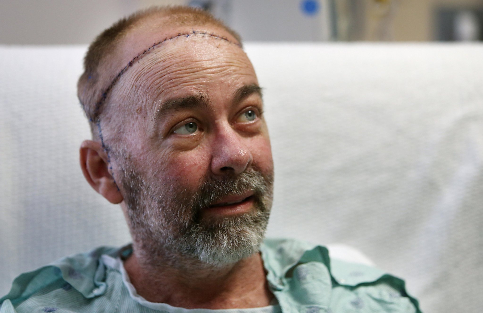 Houston doctors perform world’s first skull-scalp transplant
