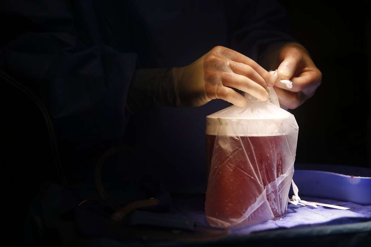 9-way kidney swap involving 18 surgeries at 2 S.F. hospitals