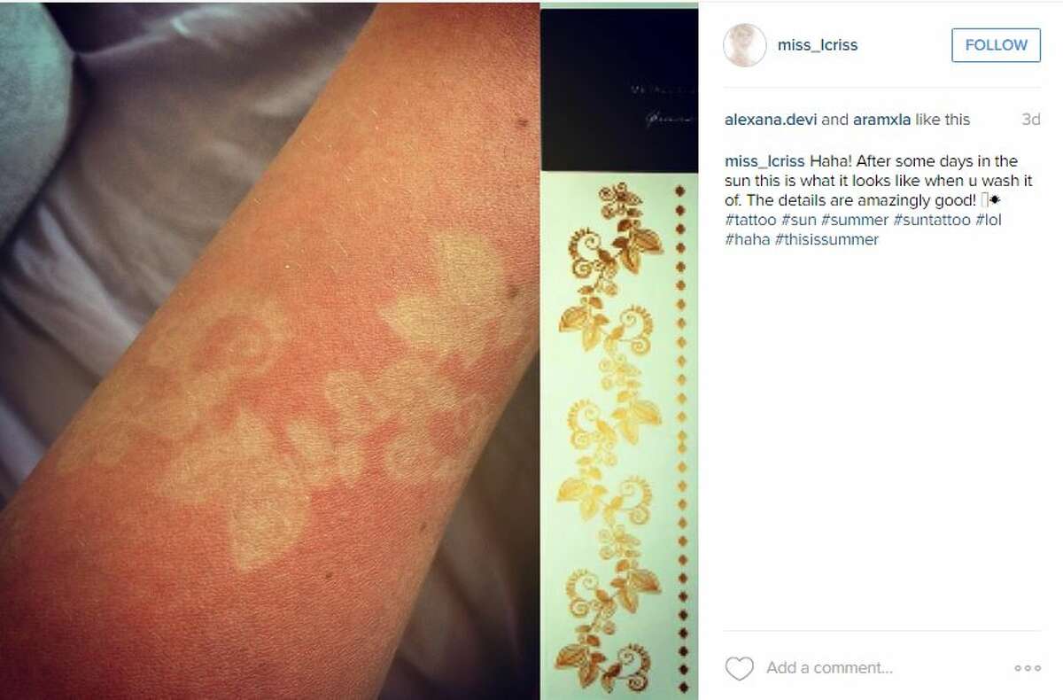 New 'sunburn tattoo' trend isn't so hot, according to experts