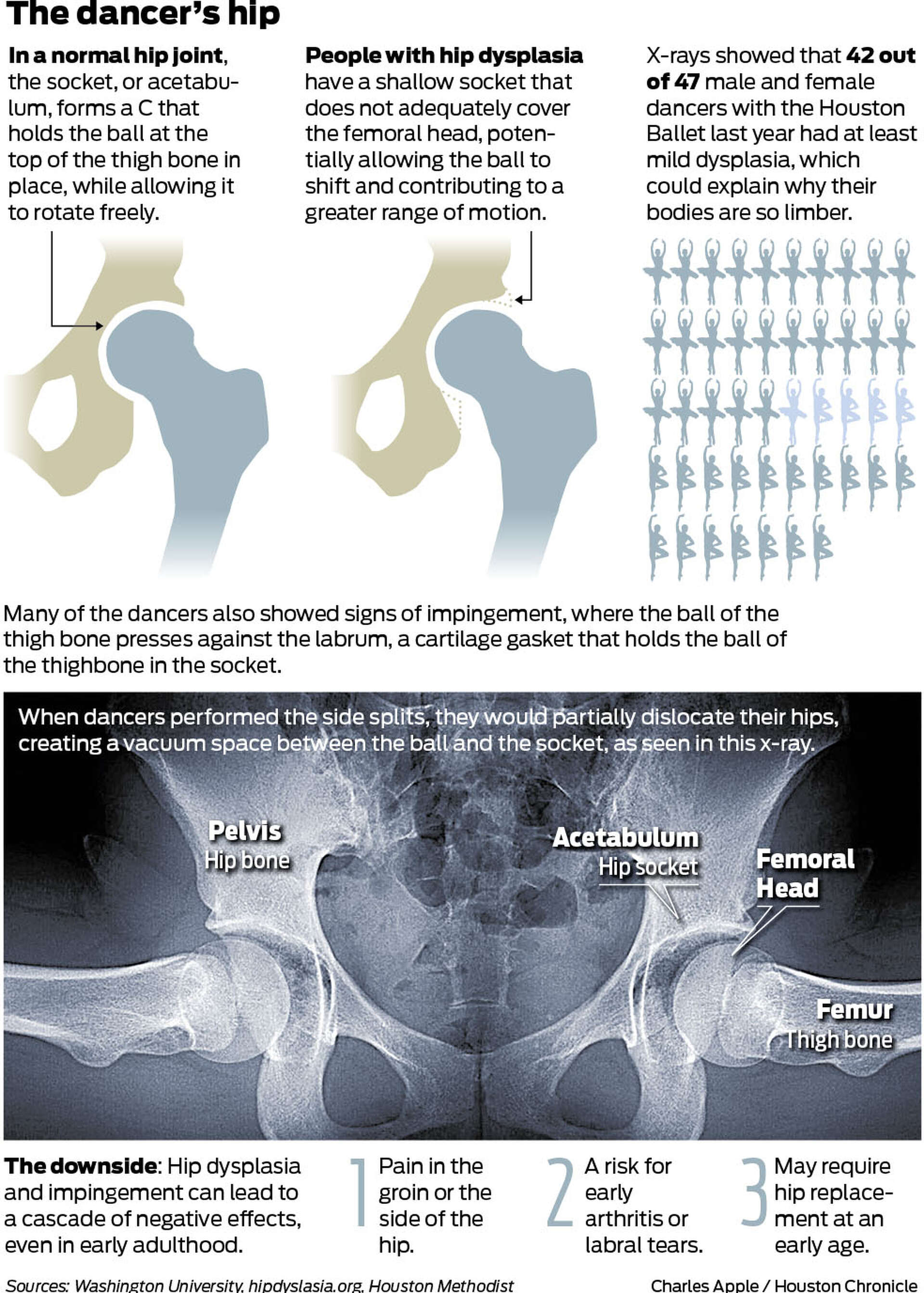 Leg up for elite dancers might lead to later problems