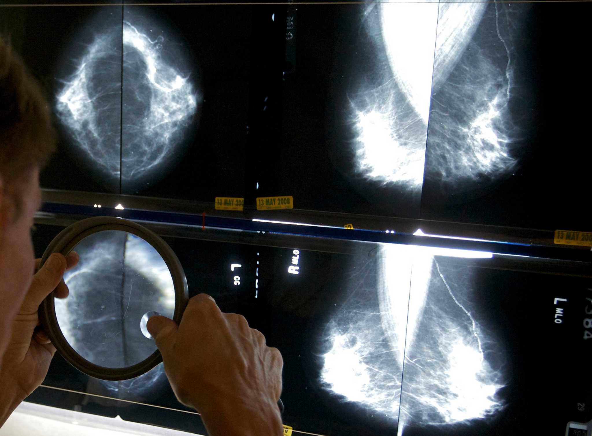 Houston invention: Artificial Intelligence to read mammograms