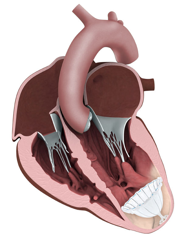 MidMichigan participates in landmark clinical trial for heart failure ...