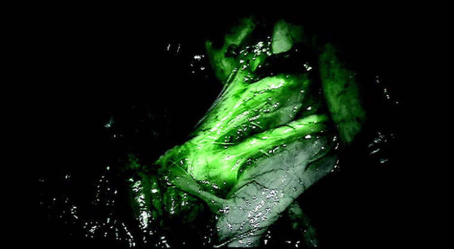 'Firefly glow' improves visibility in surgery - Midland Daily News