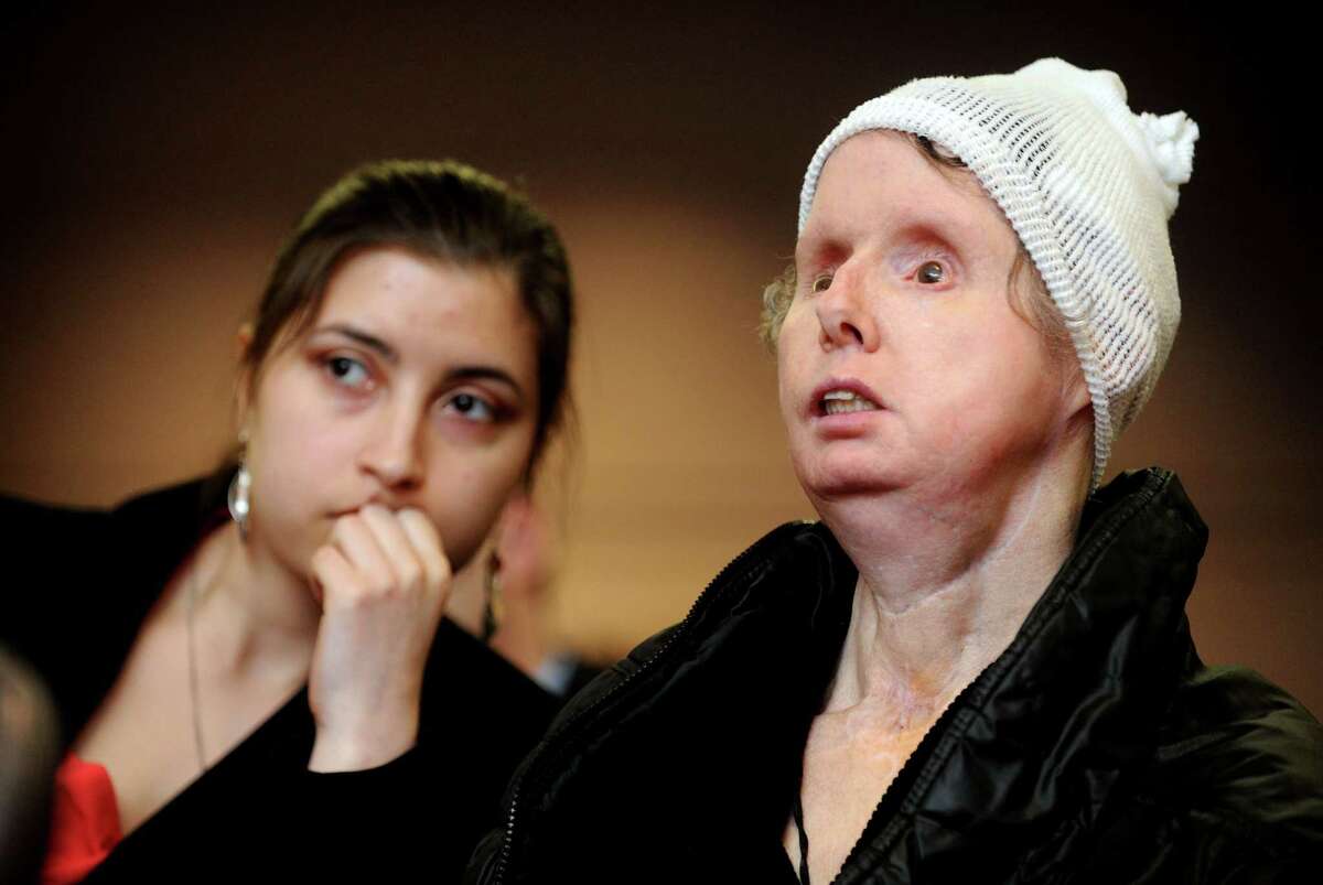 Stamford chimp victim’s body rejecting face transplant