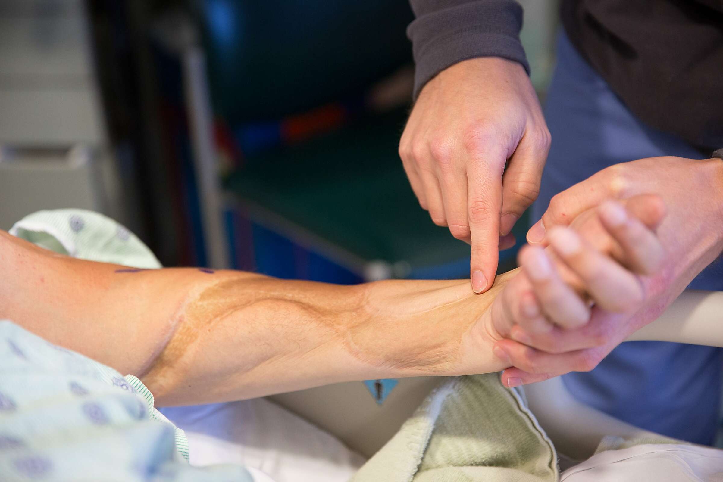 Pioneering elbow transplant at UCSF