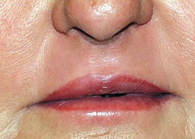 Enhanced lip line leads to improved appearance