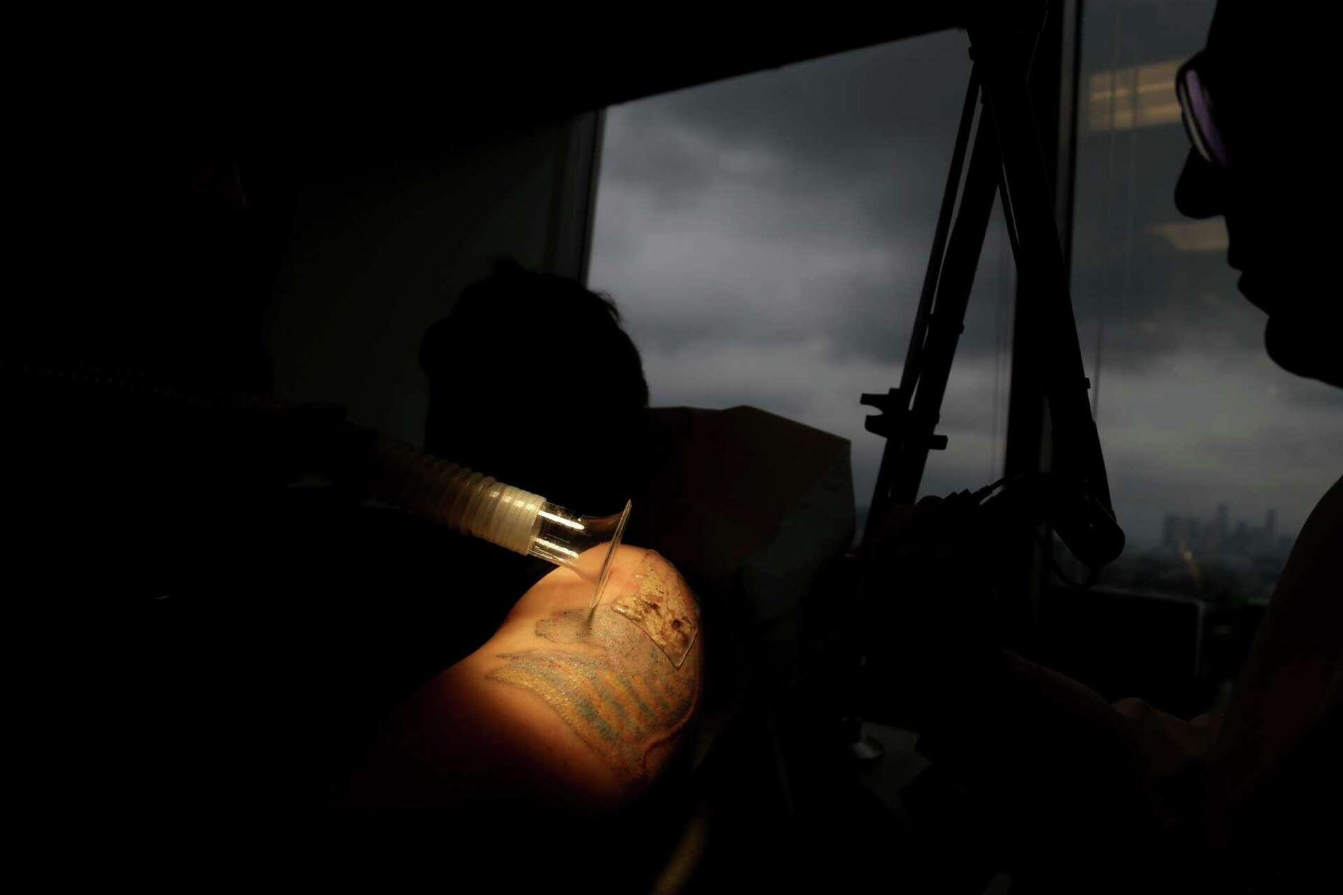 Zap that regret: Better laser speeds tattoo removal