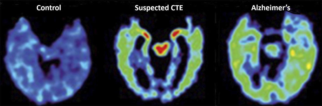 Study: Brain scans may identify concussion-related disease