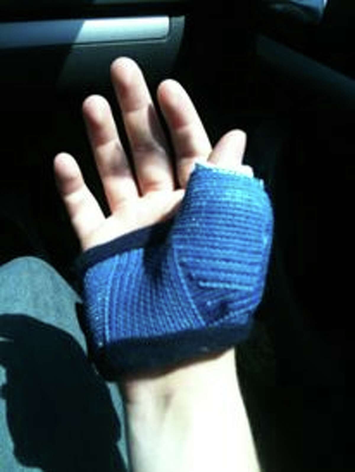 Man shares pain-inducing photos after breaking hand catching baseball ...