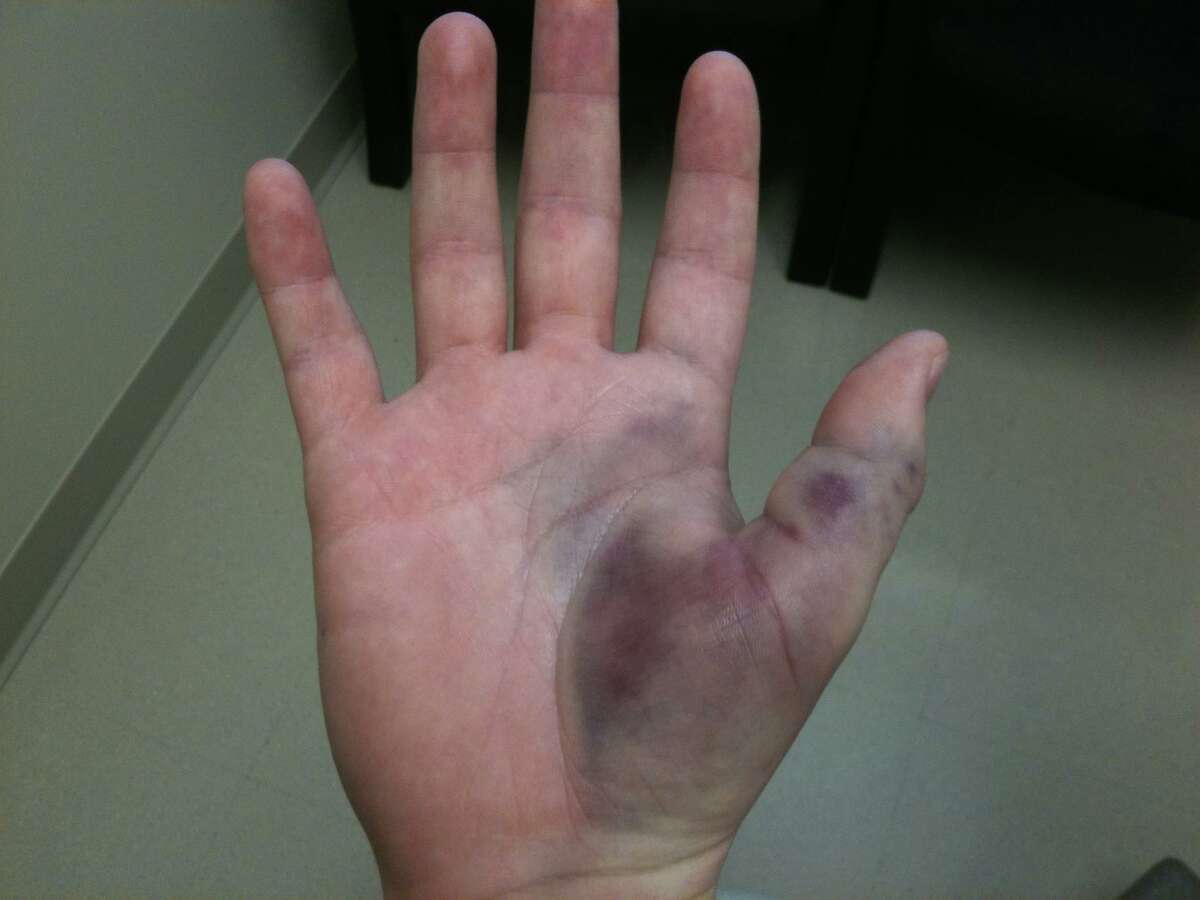 Man shares pain-inducing photos after breaking hand catching baseball ...