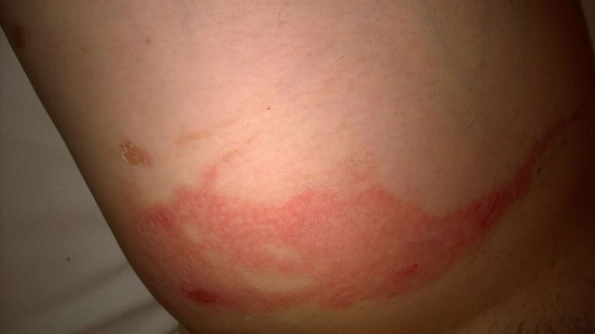 Houston attorney suing Starbucks over alleged coffee burns