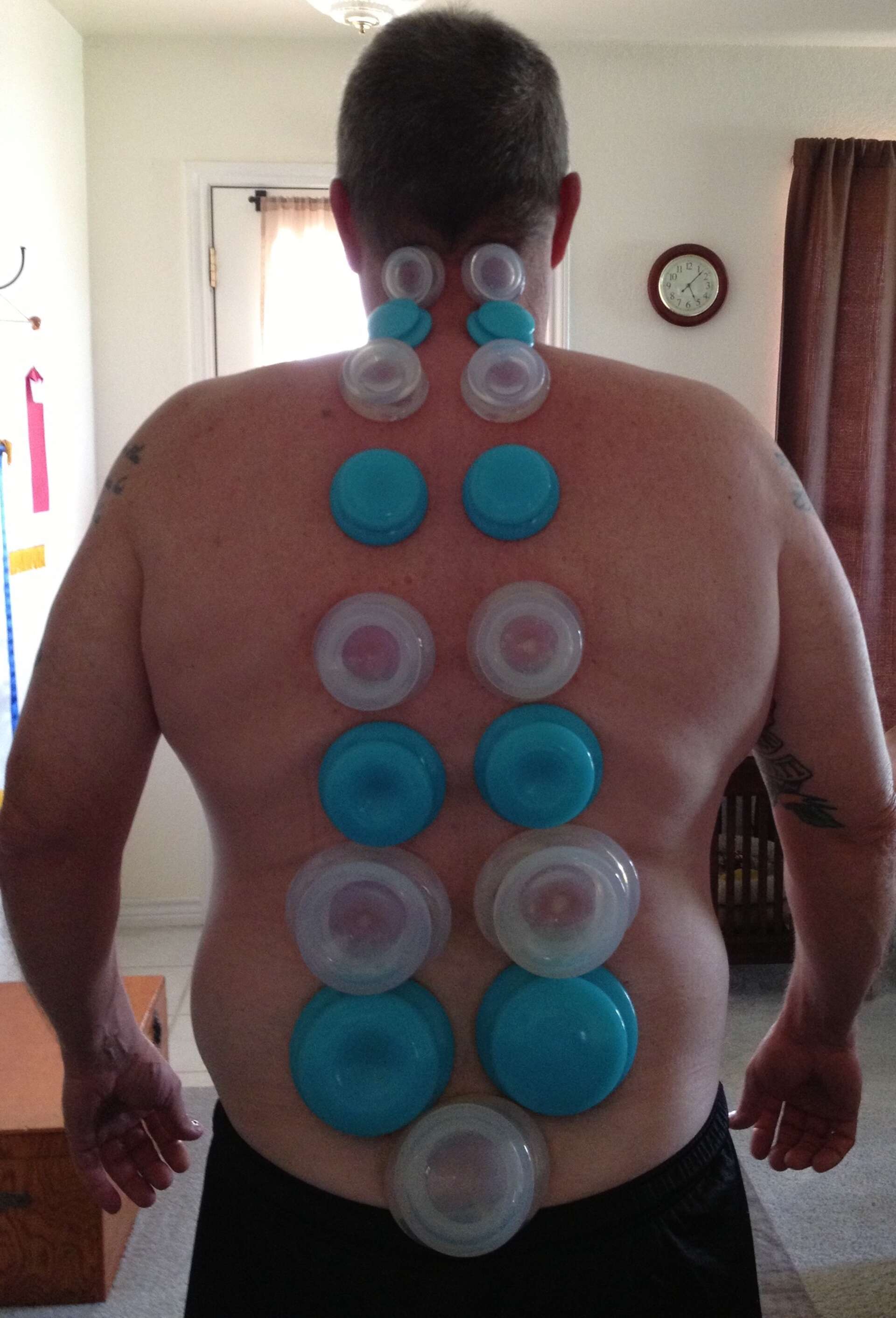 Olympic athletes start trend with visible cupping bruises