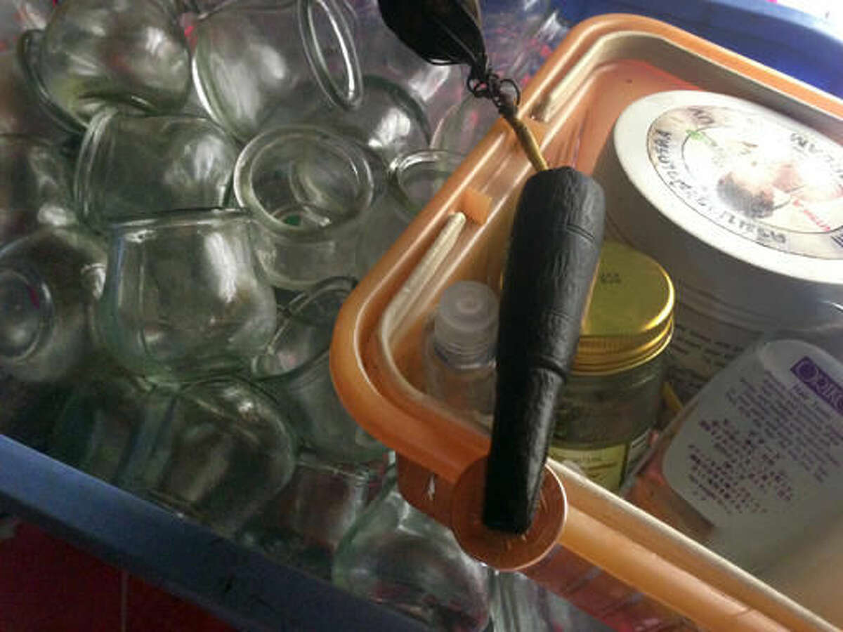 Cupping and Coining: I did it long before Phelps