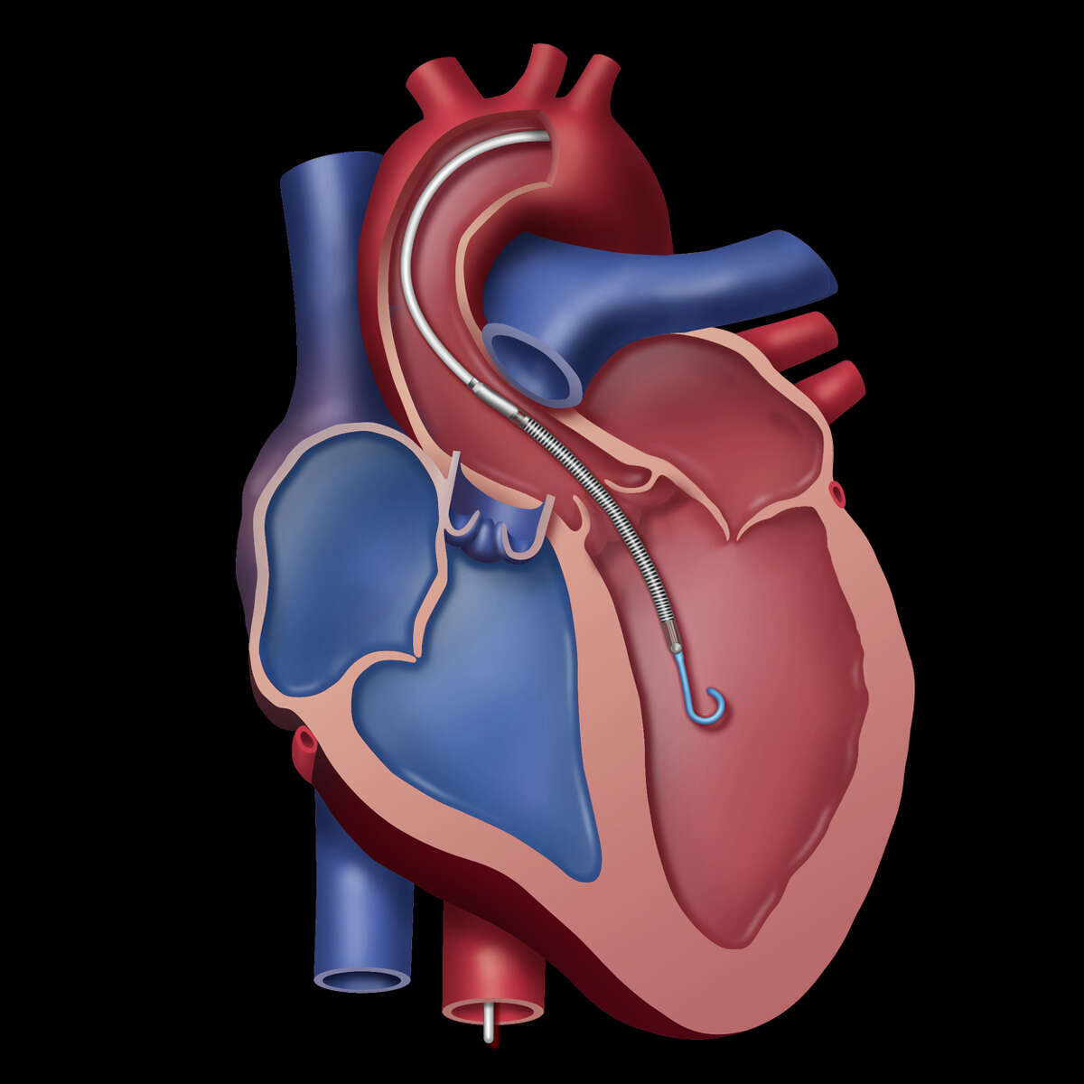 Heart pump aids patients too weak for surgery