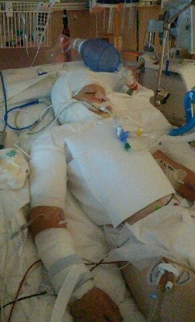 10-year-old Kerrville boy in a coma after suffering severe burns