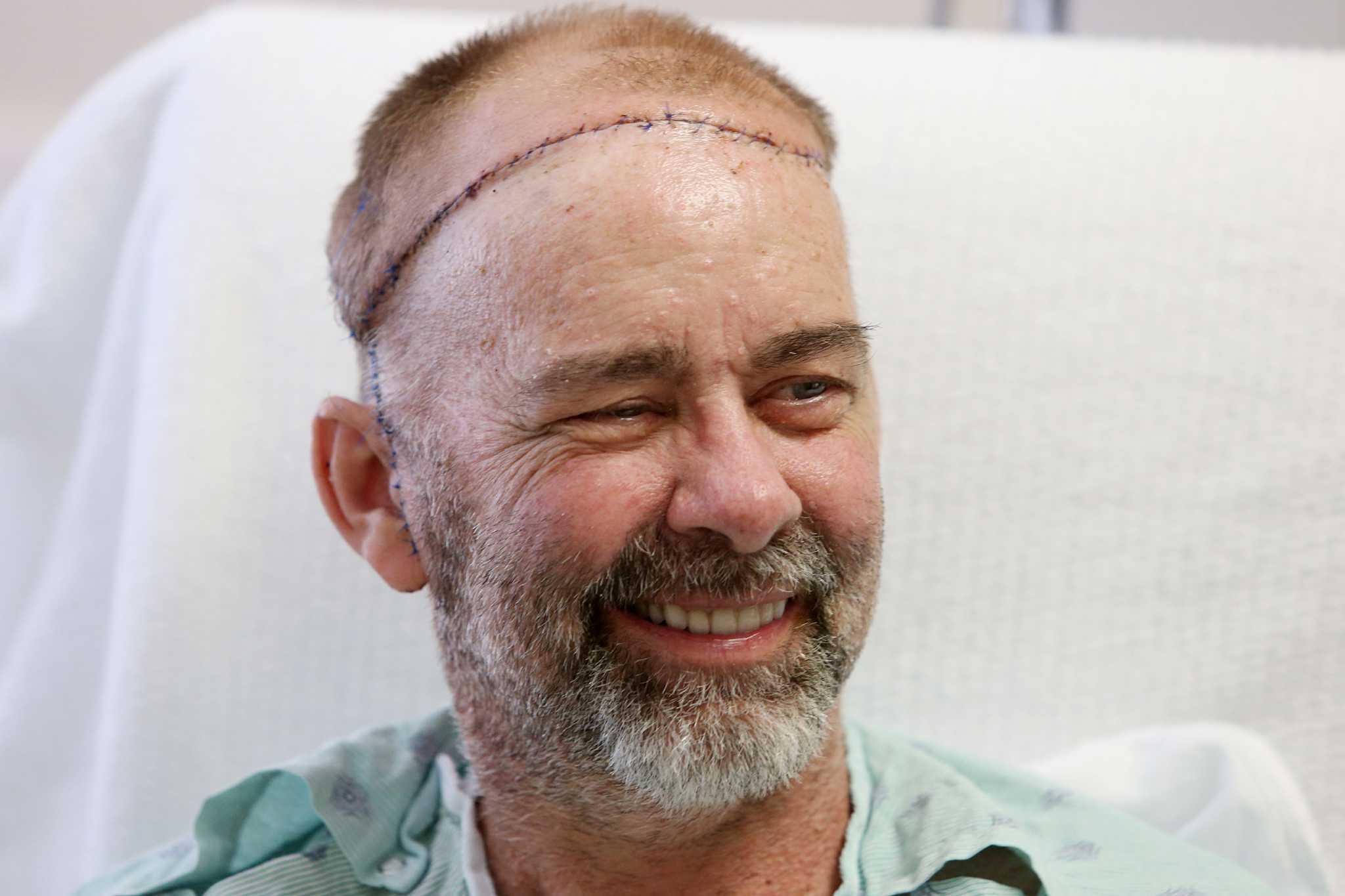 Skull and scalp transplant first one of its kind, brought Houston ...