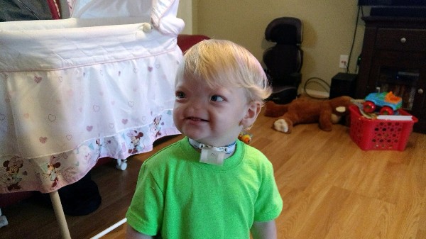 Baby boy born without a nose dies at 2 years old