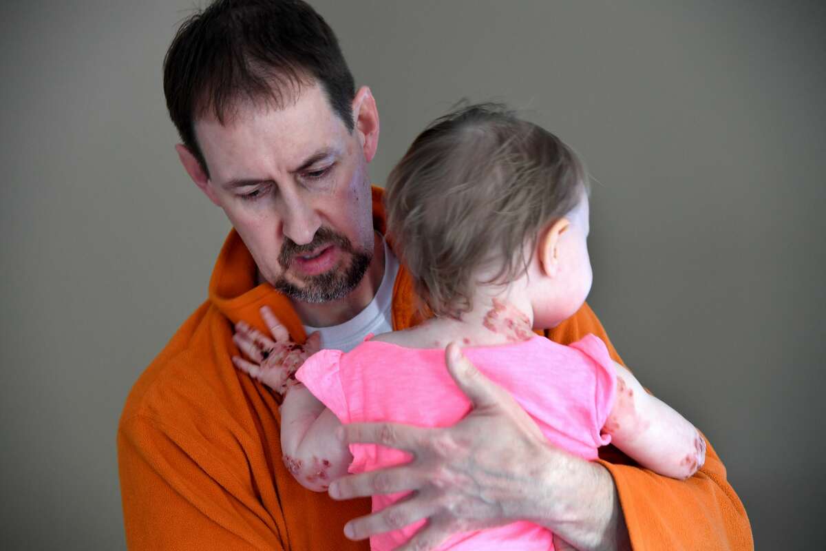 'The worst disease you've never heard of' makes children's skin as ...